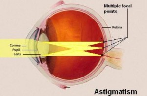REFRACTIVE ERROR – Dr Rajiv Desai