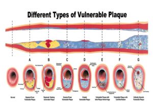 VULNERABLE PLAQUE – Dr Rajiv Desai