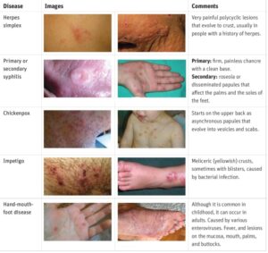 Monkeypox (Tinypox) – Dr Rajiv Desai